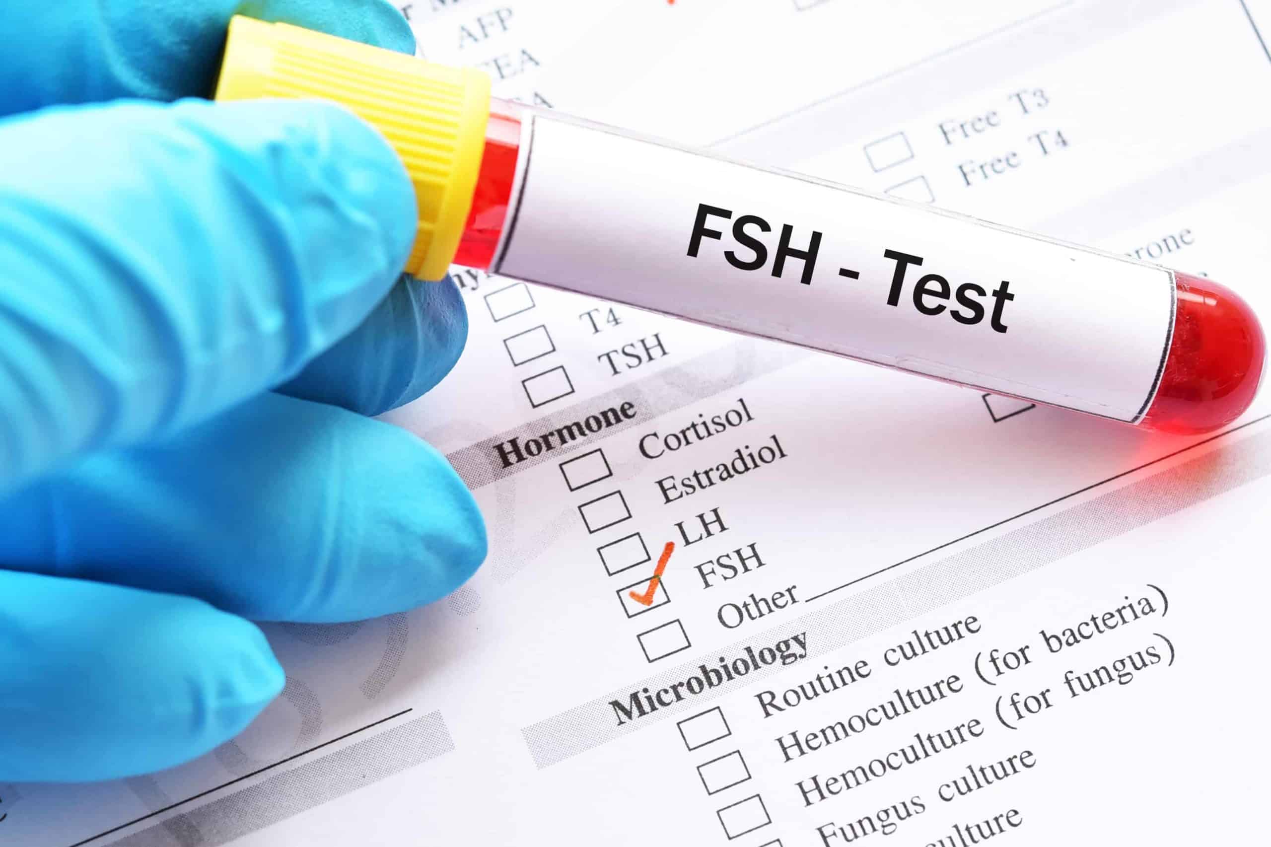 Folikulostimulirajući hormon (FSH) - Labos laboratorij Sarajevo - M. Dvor